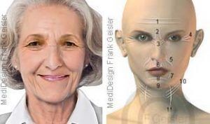 Botox, Botolinumtoxin gegen Falten