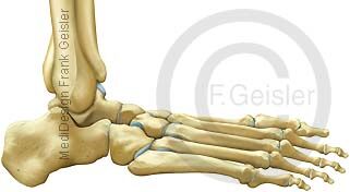 Erkrankung Fuß, Arthrose Sprunggelenk