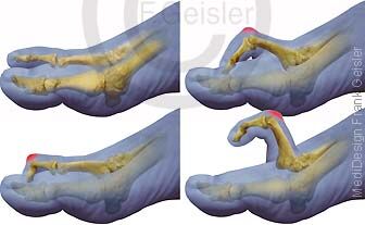 Spreizfuß, Fehlstellung am Fuß