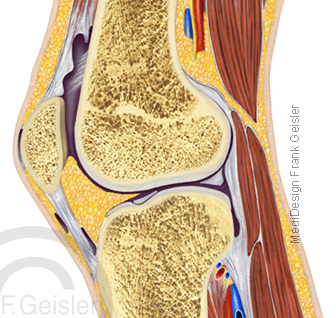 Arthrose Knie, künstliches Kniegelenk