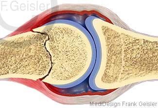 Knochenbrüche, Frakturen der Knochen