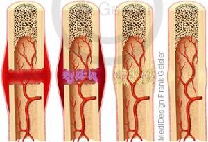 Knochenbrüche, Frakturen der Knochen