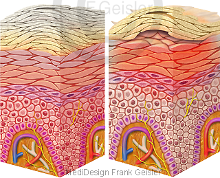 Dermatosen, Erkrankungen der Haut